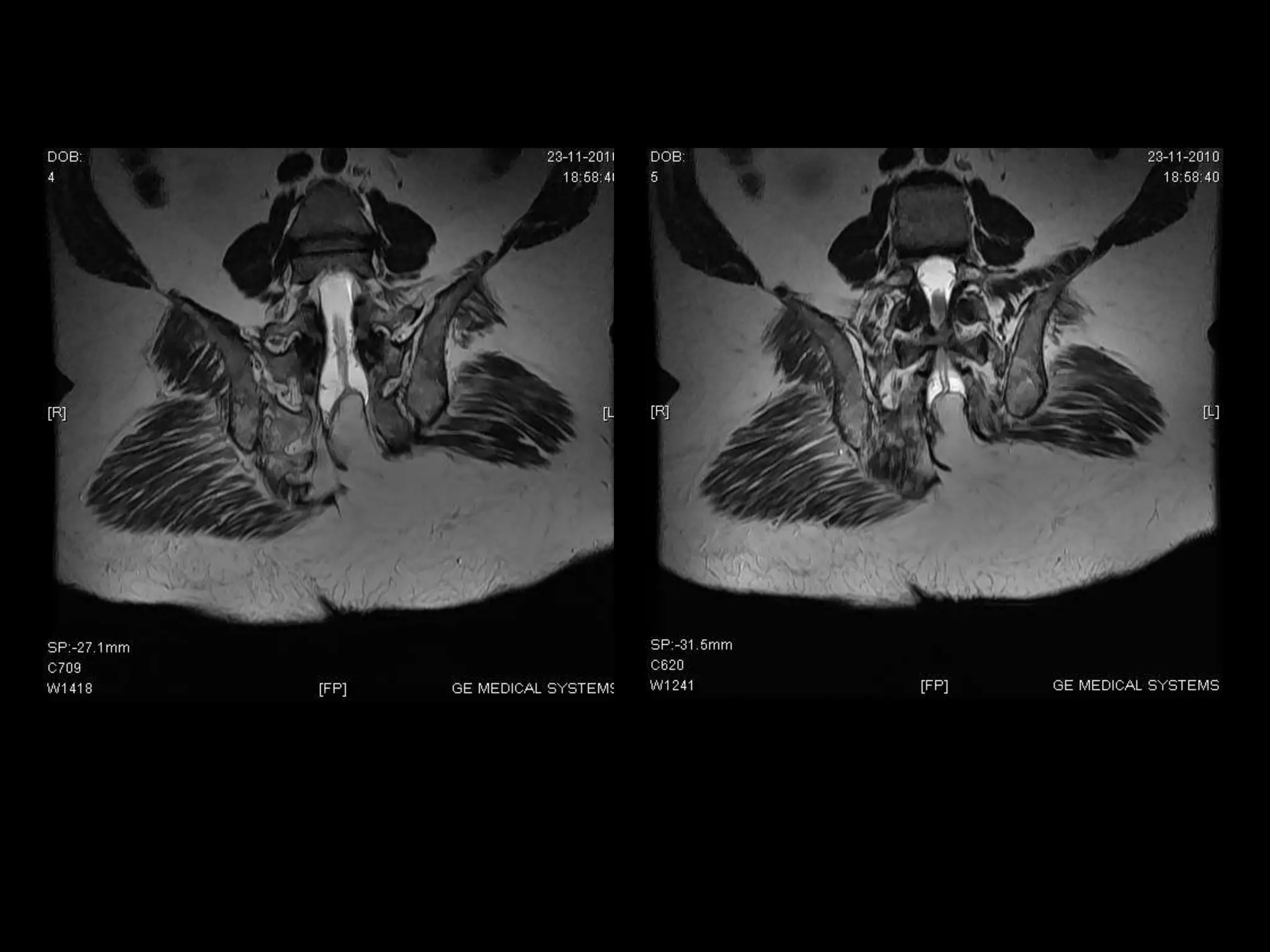 Lipomyelocele powerpoint presentation. | PPTX