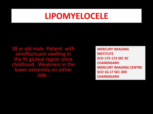 Lipomyelocele powerpoint presentation. | PPTX