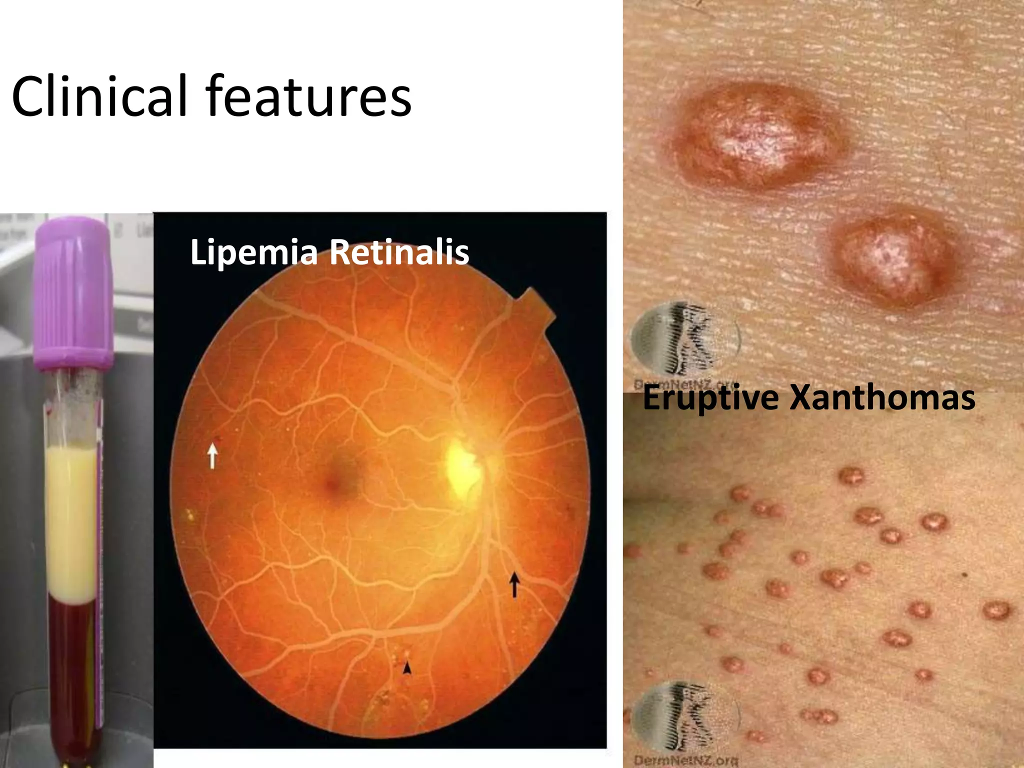 Disorders of Lipoprotein Metabolism | PPTX