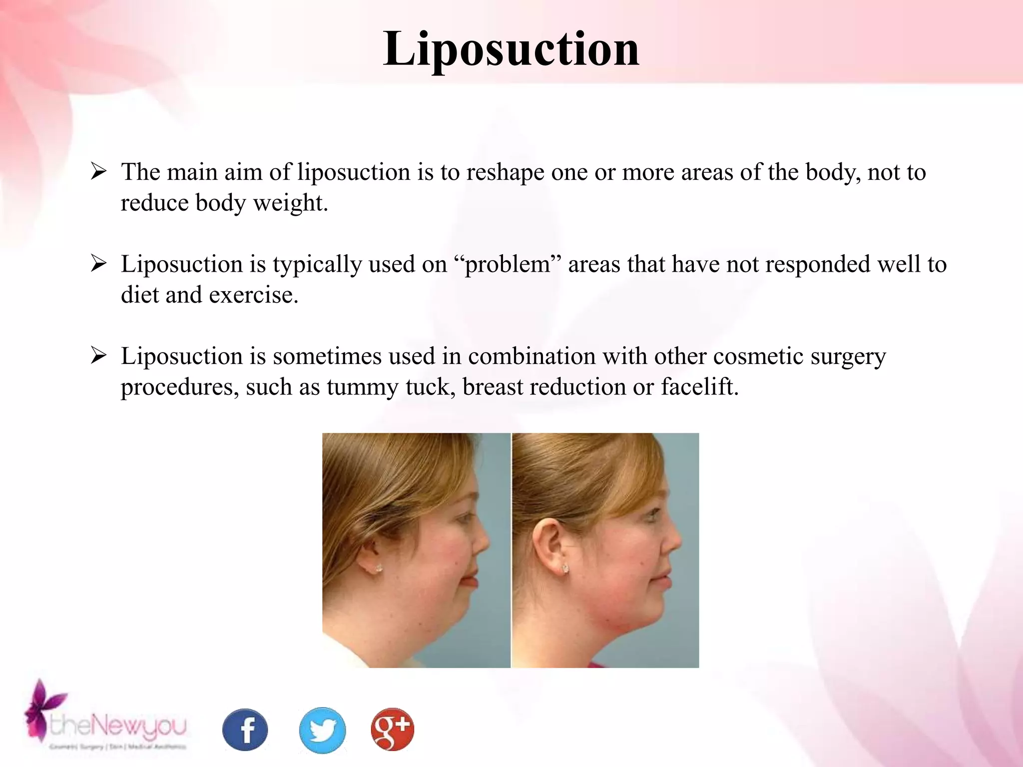 Liposuction | PPTX