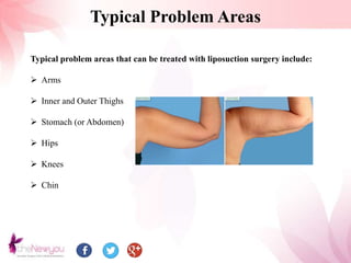 Liposuction | PPTX