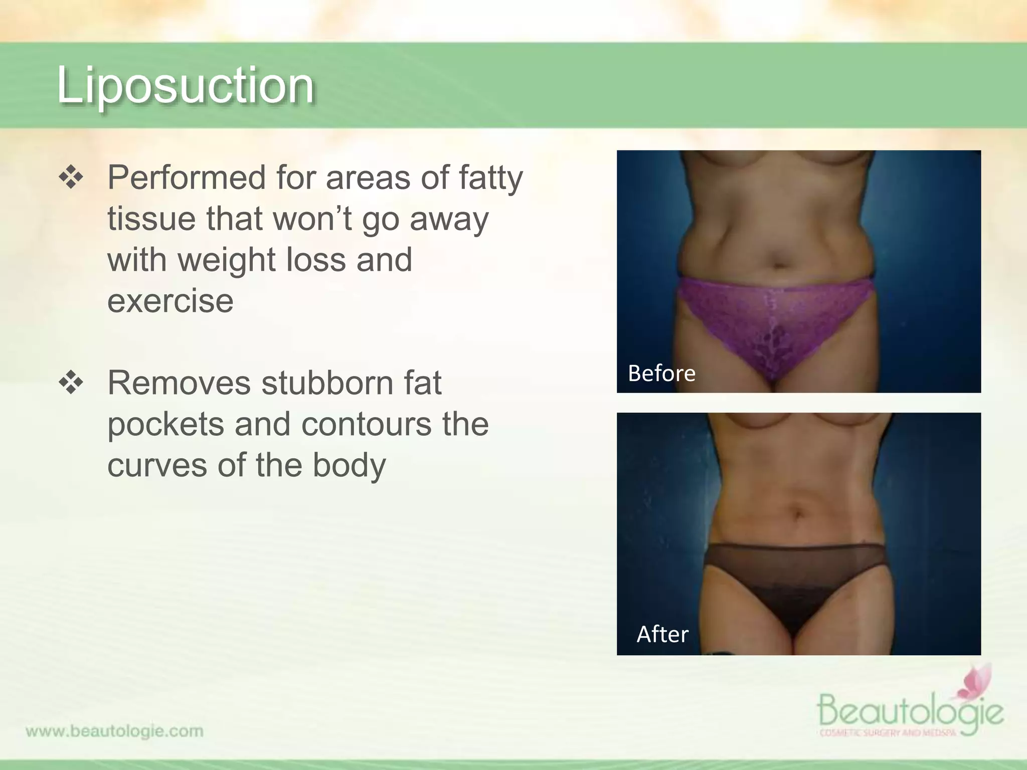 Liposuction by Beautologie Plastic Surgery | PPTX