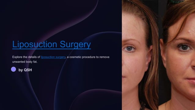 Liposuction-Surgery quttainah Dubai.pptx