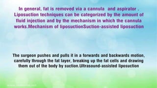 What are the Different Liposuction Techniques | PPTX
