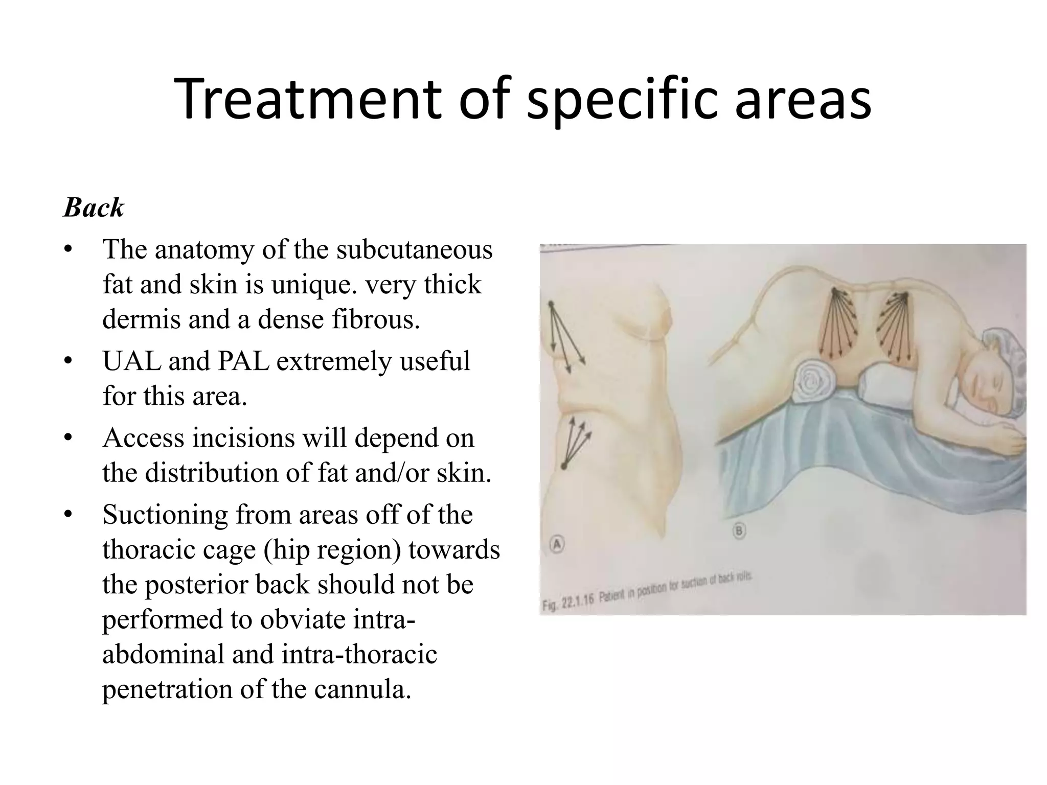 Liposuction by various method | PPTX