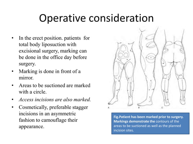Liposuction by various method | PPTX | Skin and Dermatology | Diseases and Conditions