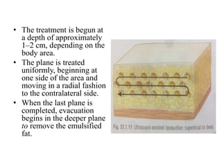 Liposuction by various method | PPTX