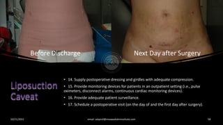 Liposuction Complications