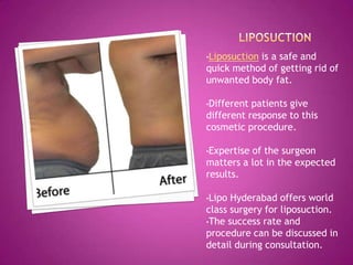 Liposuction hyderabad | PPT