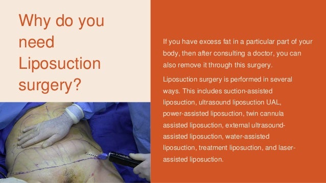 LIPOSUCTION SURGERY EVERYTHING YOU WANT TO KNOW | PPTX