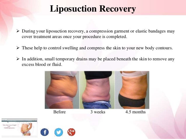 All You Need to Know About Liposuction