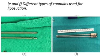 Liposuction used to treat deep vascular accesses for hemodialysis.pptx