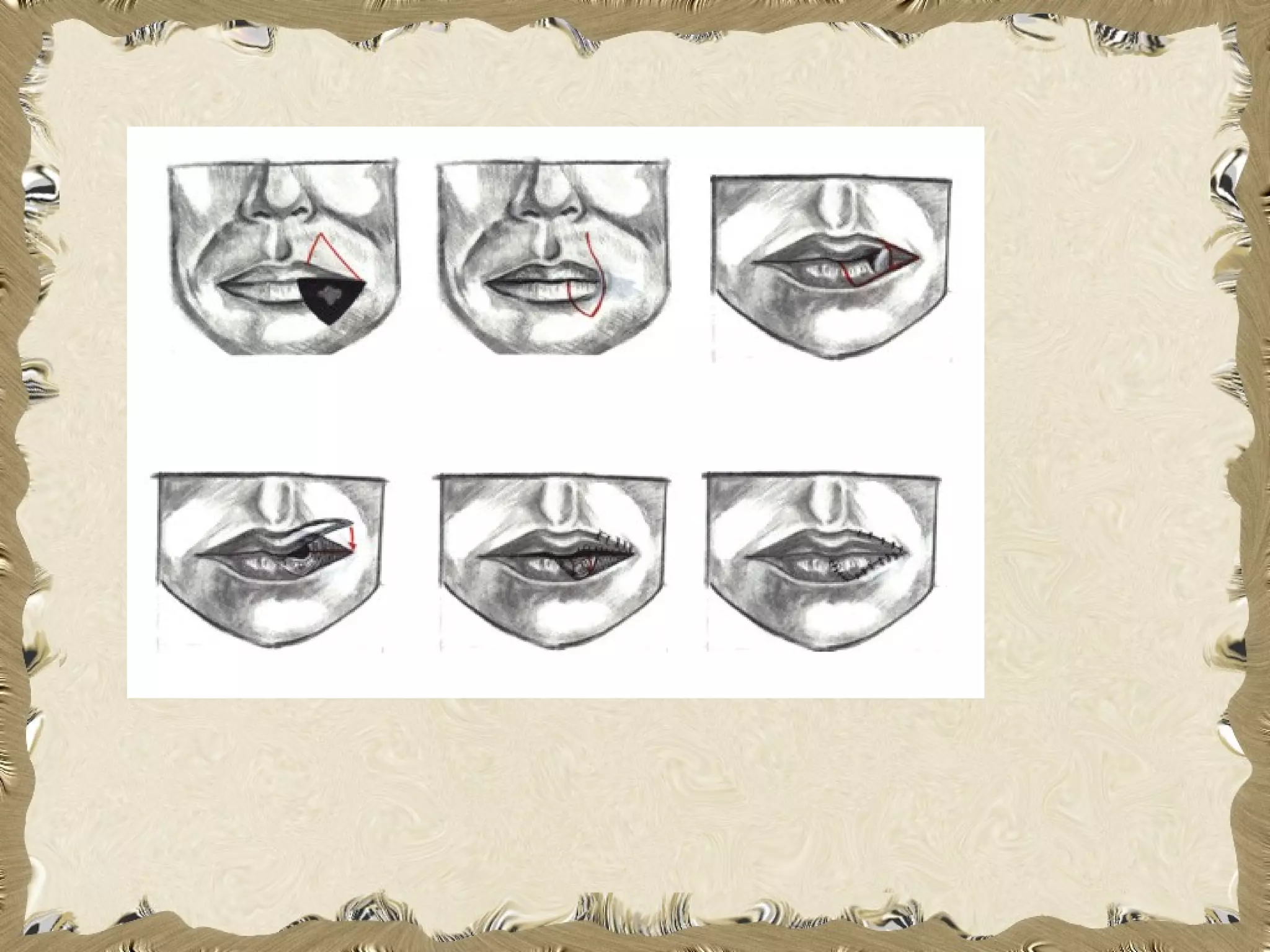 Lip reconstruction | PDF