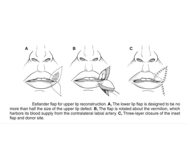 Lip Reconstruction.pptx | Cosmetic Medical Services | Medical Health
