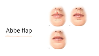 Lip Reconstruction: Algorithm for managing lip defects.pptx