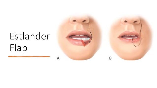 Lip Reconstruction: Algorithm for managing lip defects.pptx