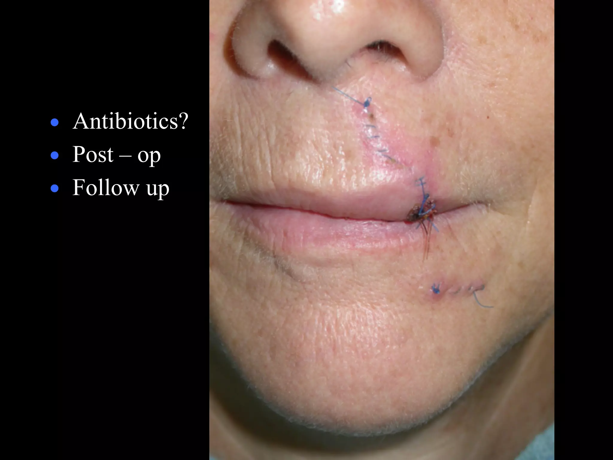 Lip Reconstruction Following Traumatic Lip Injuries | Dr. Alfred ...