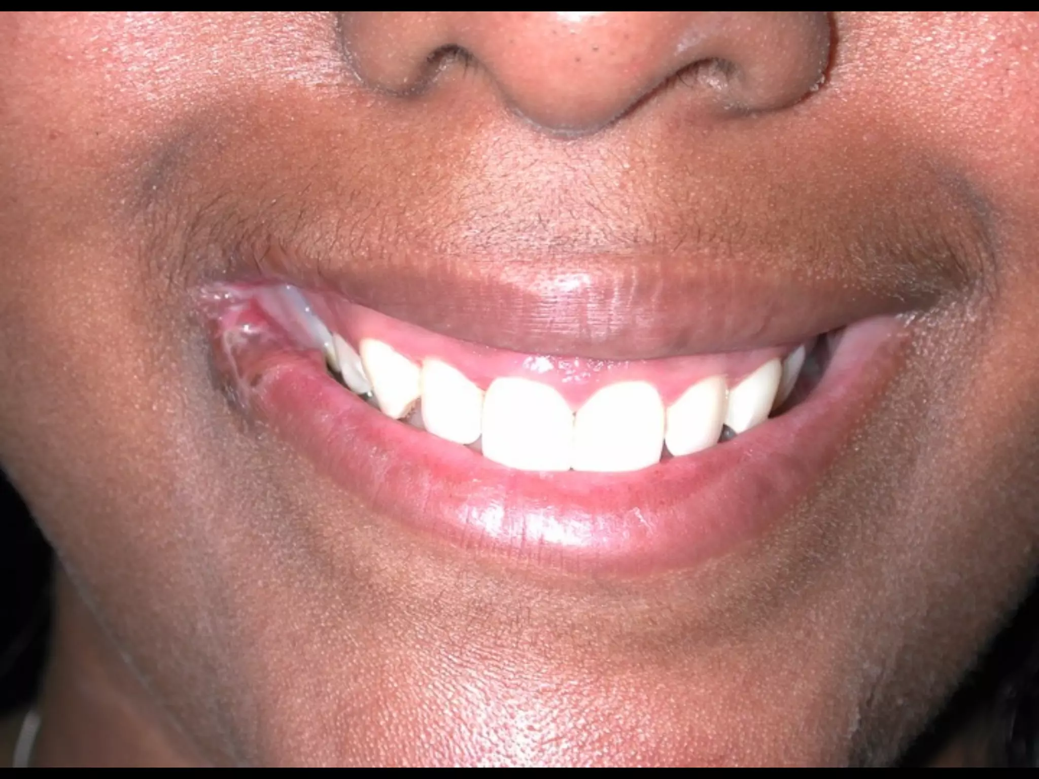 Lip Reconstruction Following Traumatic Lip Injuries | Dr. Alfred ...