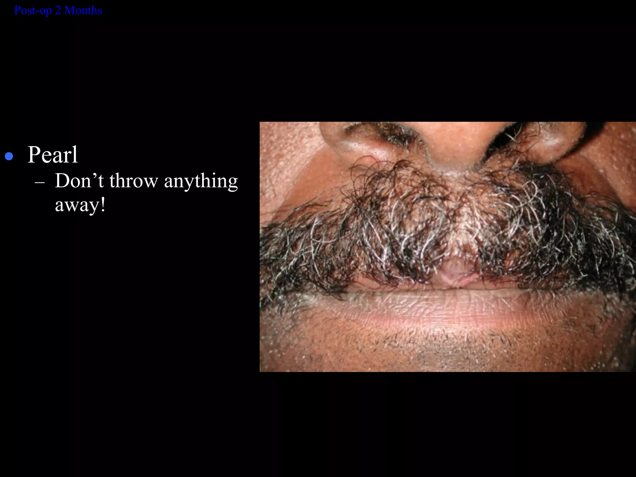 Lip Reconstruction Following Traumatic Lip Injuries | Dr. Alfred ...