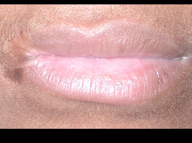 Lip Reconstruction Following Traumatic Lip Injuries | Dr. Alfred ...