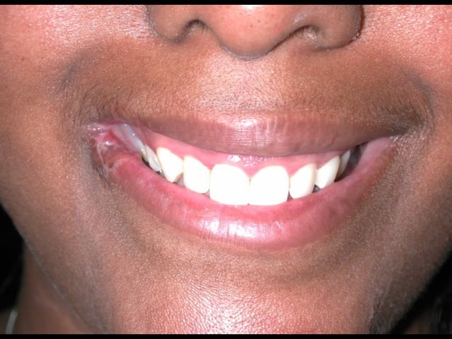 Lip Reconstruction Following Traumatic Lip Injuries | Dr. Alfred ...