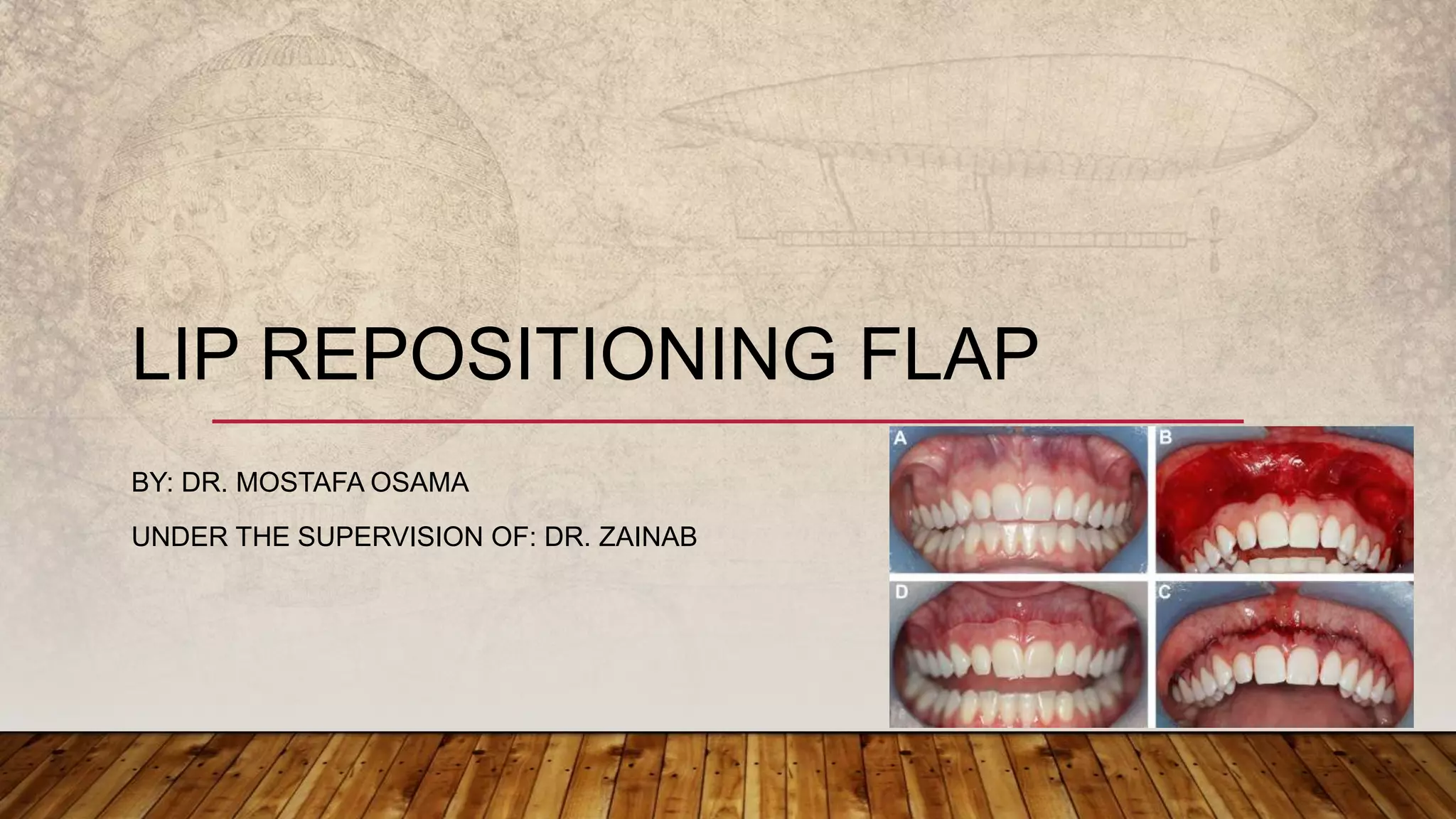 Lip Repositioning flap.pptx
