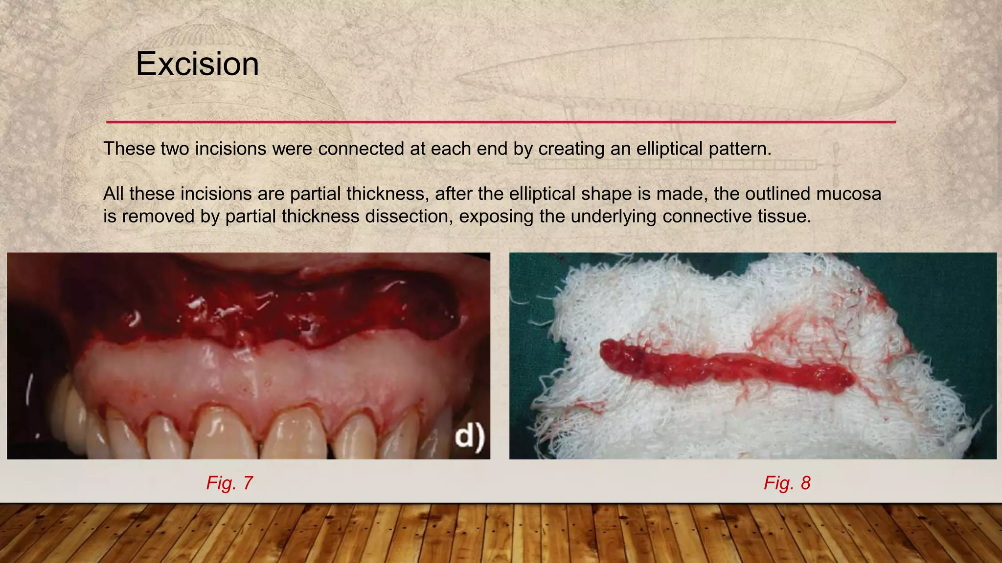 Lip Repositioning flap.pptx