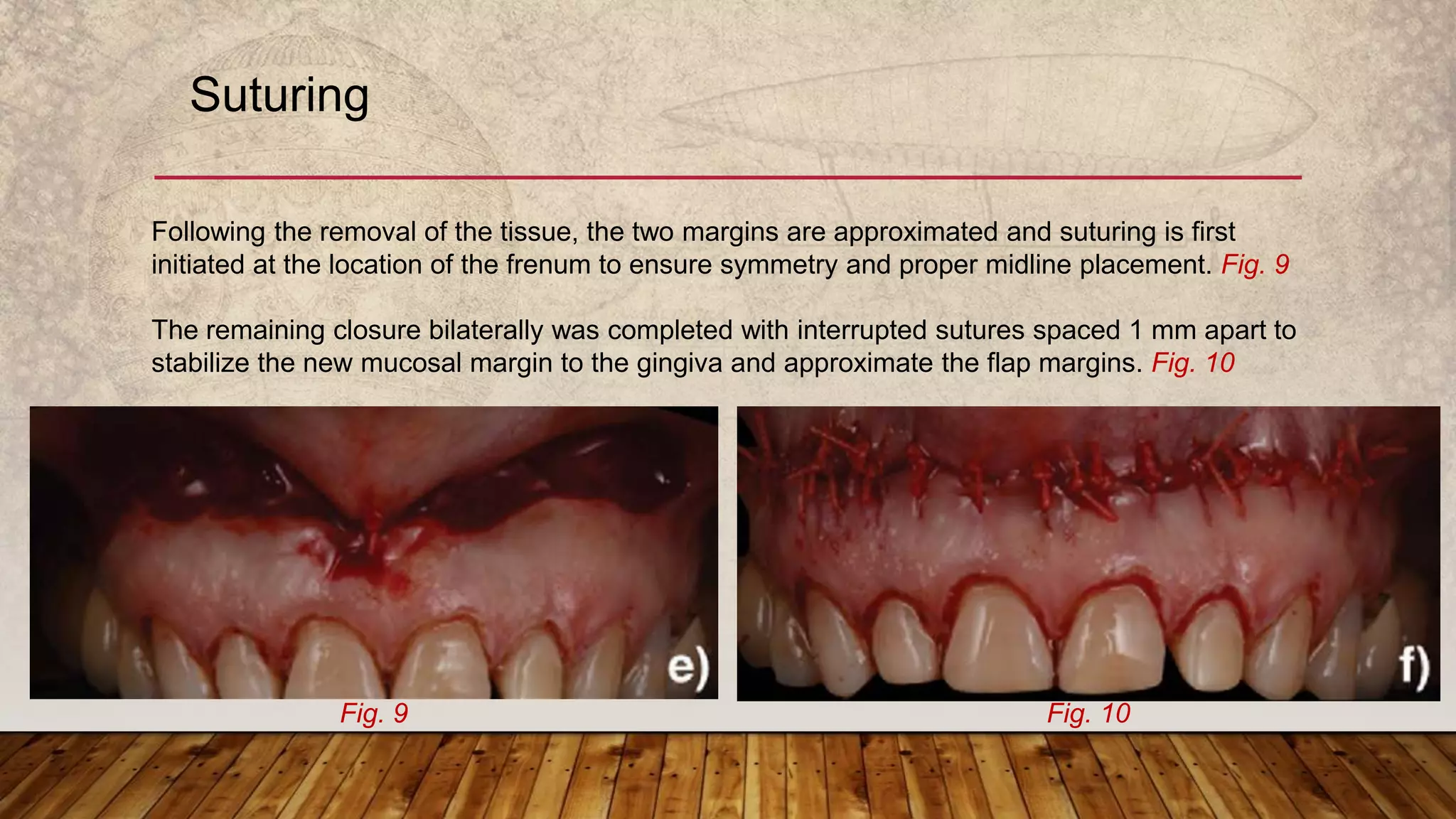 Lip Repositioning flap.pptx