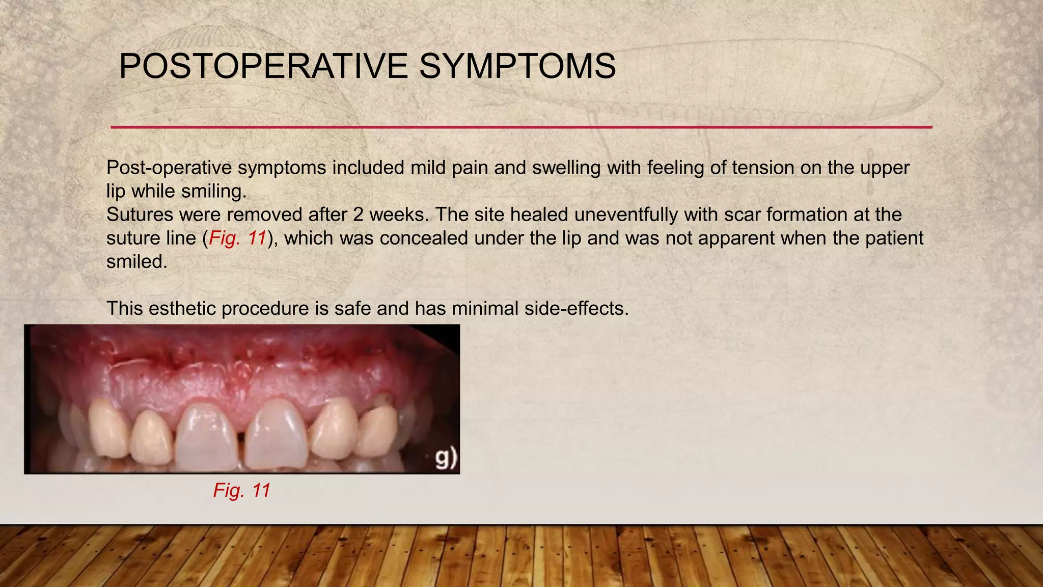 Lip Repositioning flap.pptx
