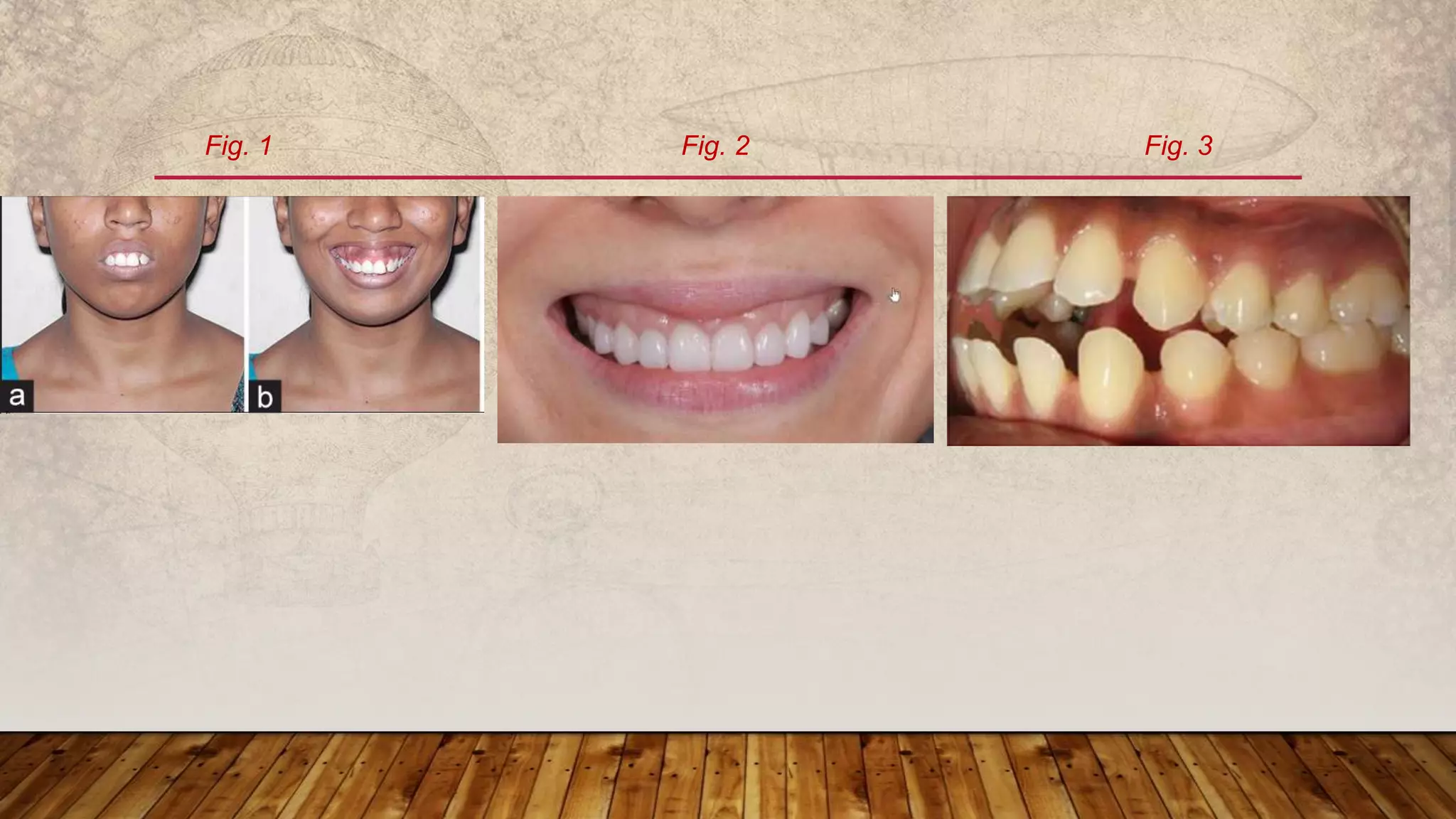 Lip Repositioning flap.pptx