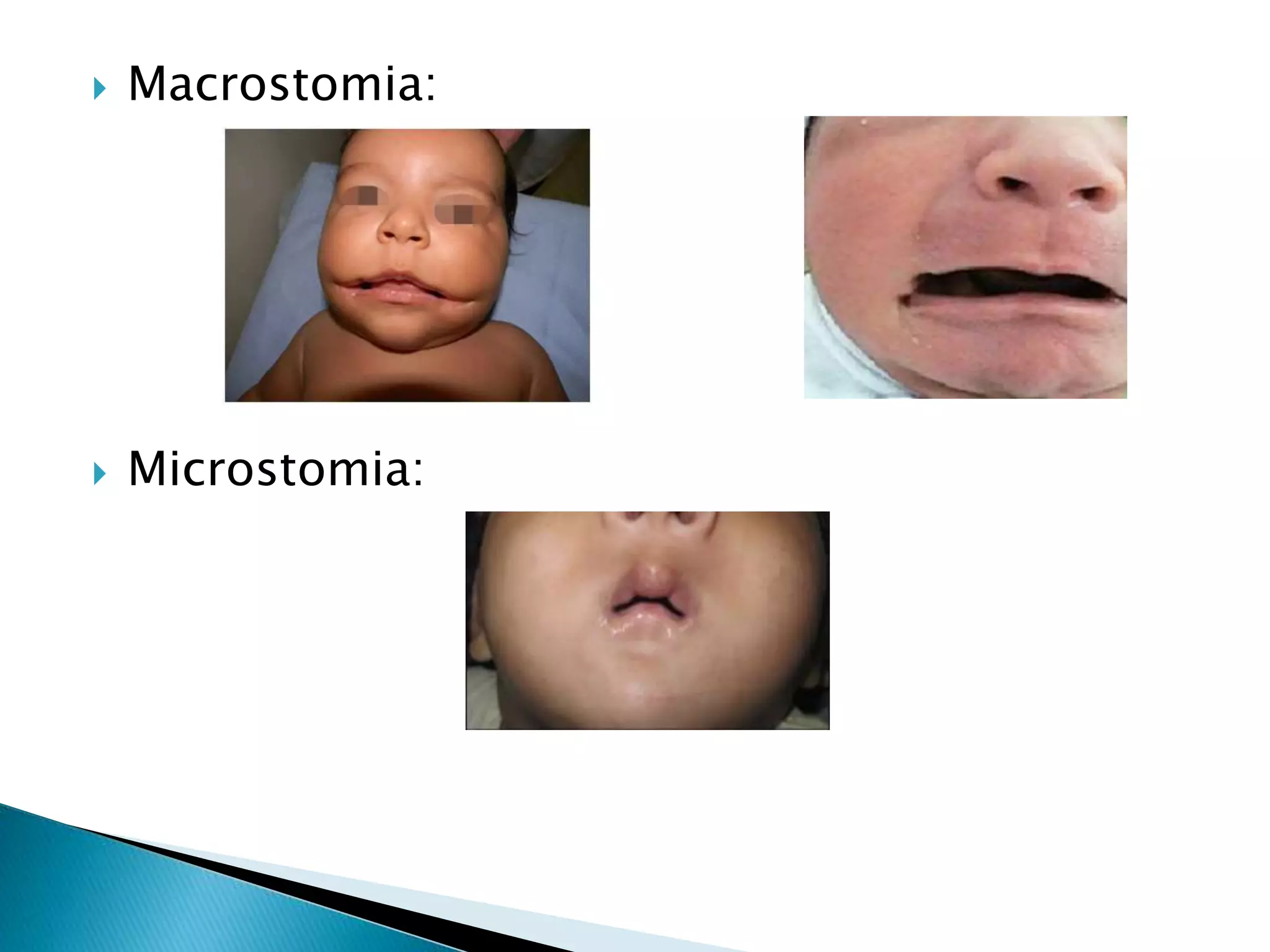 Lips tongue and palate | PPTX