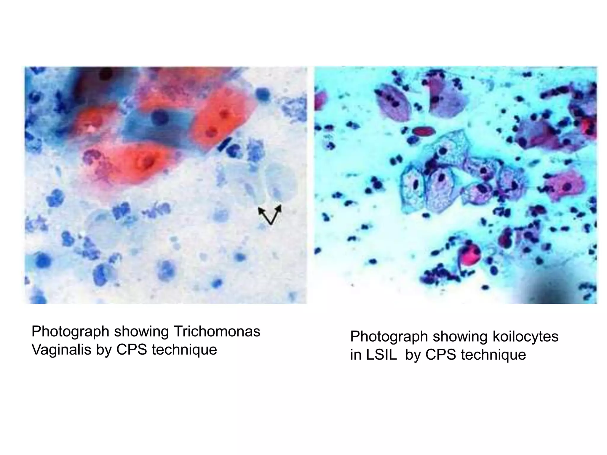 Liquid based cytology | PPTX