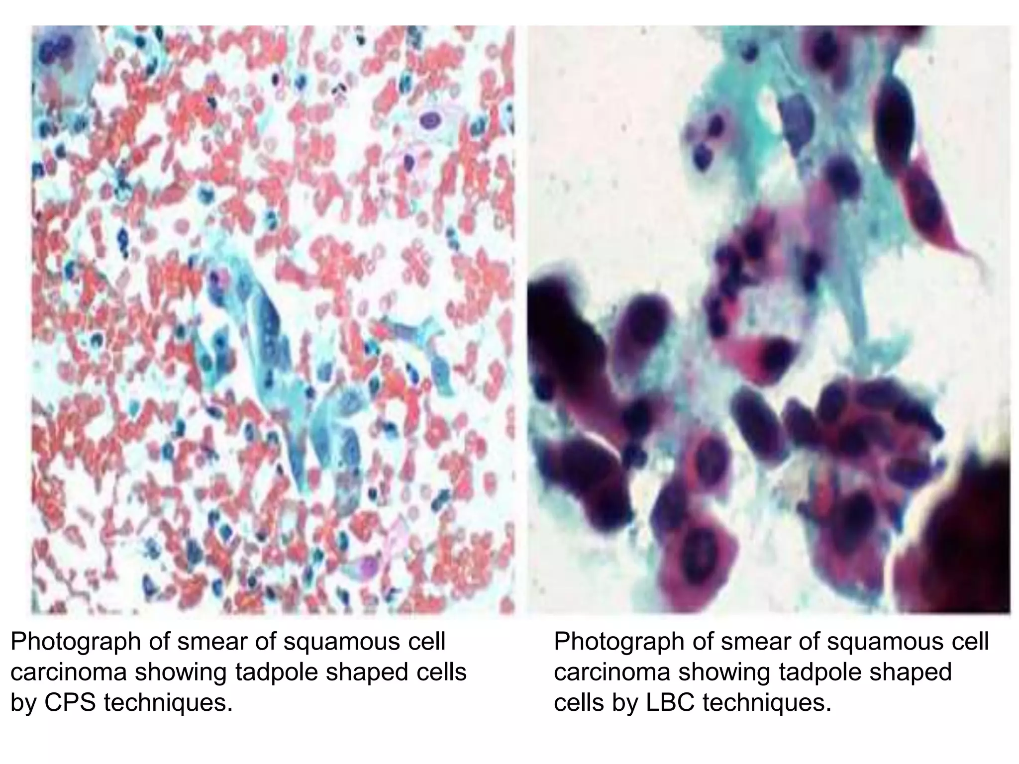 Liquid based cytology | PPTX