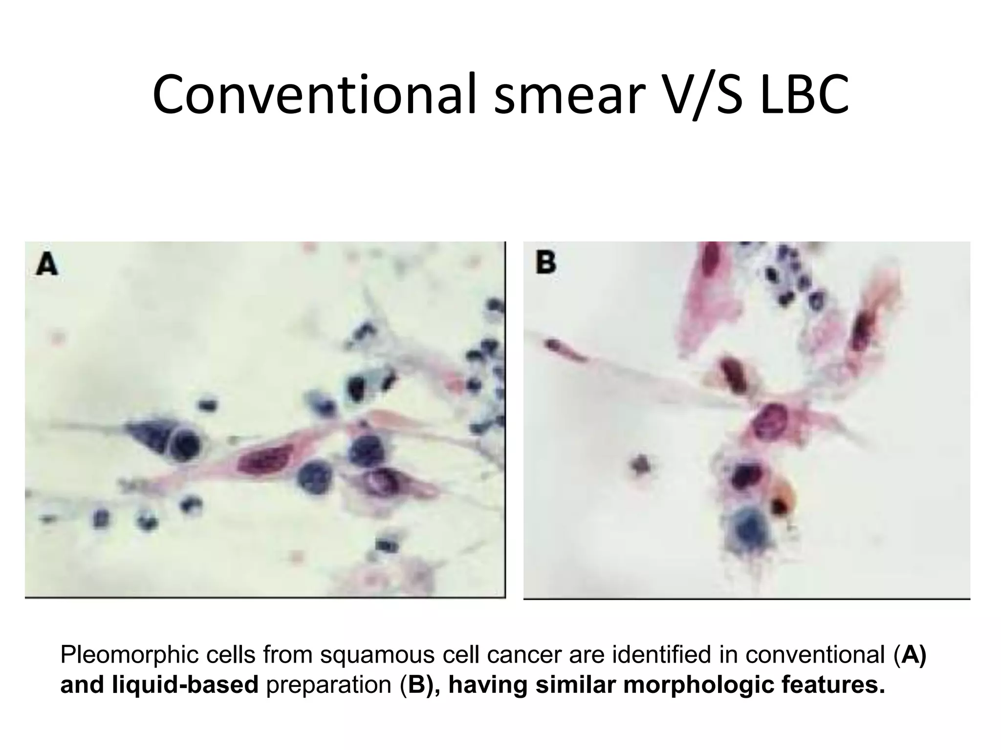 Liquid based cytology | PPTX