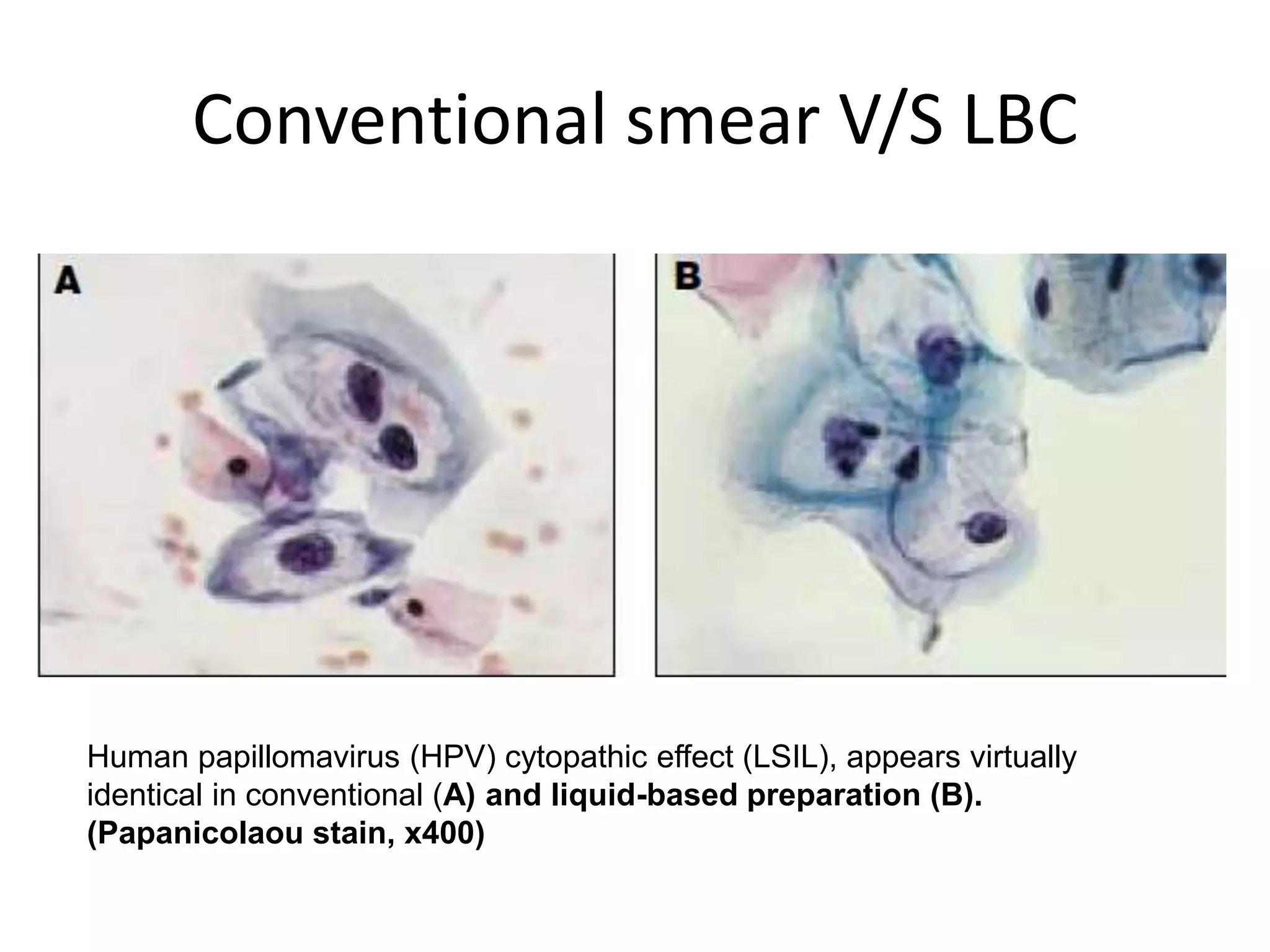 Liquid based cytology | PPTX