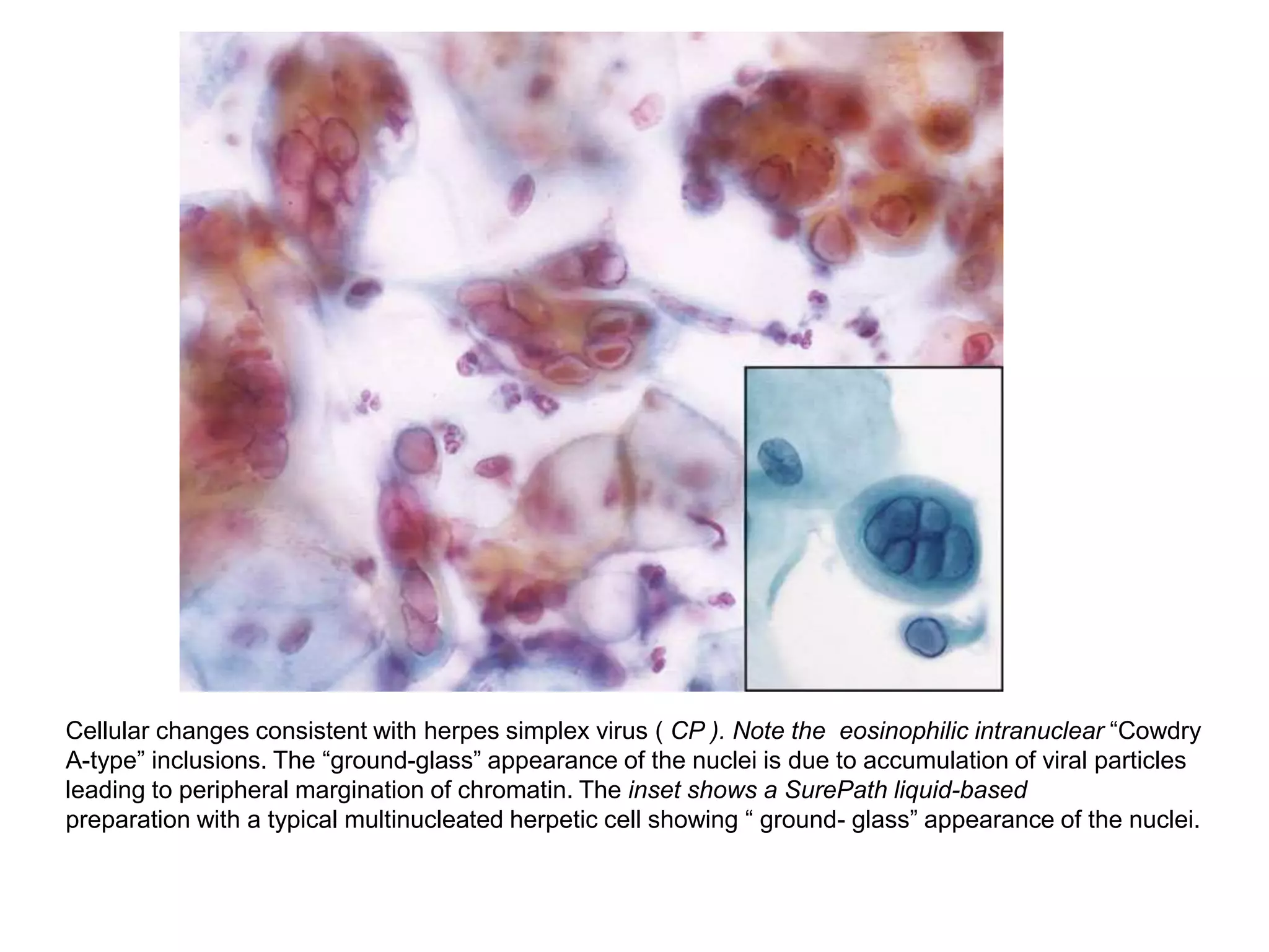 Liquid based cytology | PPTX