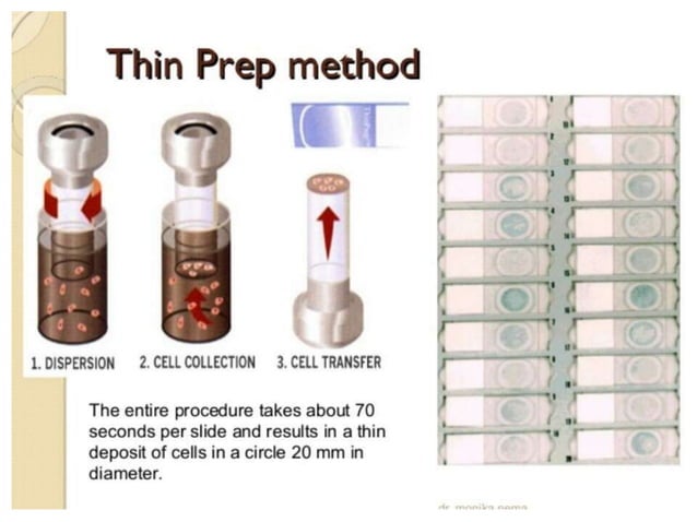 Liquid based cytology | PPTX | Medical Tests | Medical Health
