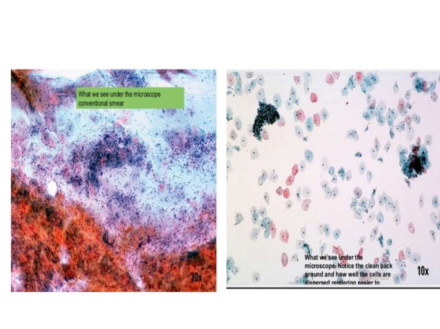 Liquid based cytology | PPTX | Medical Tests | Medical Health