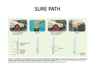 Liquid Based Cytology