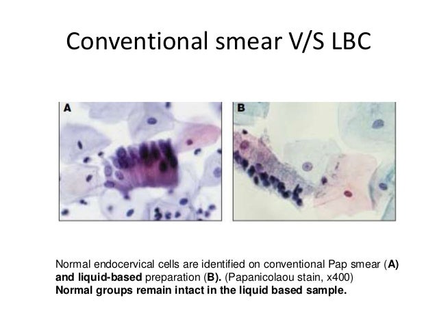Liquid based cytology