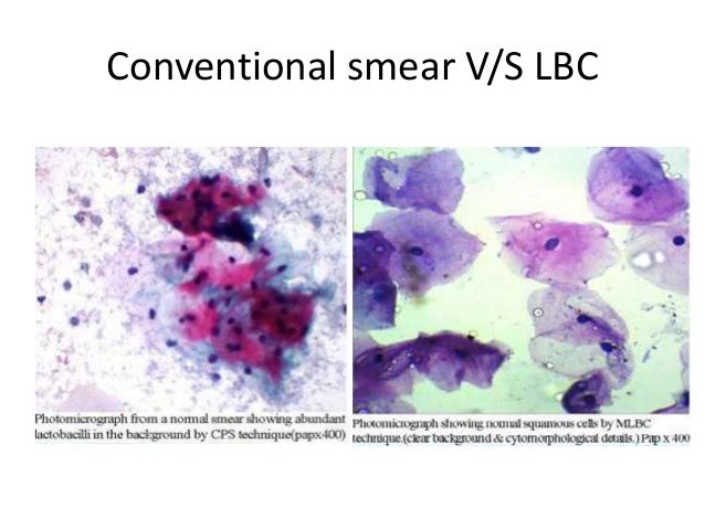 Liquid based cytology