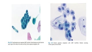 Liquid Based Cytology by Dr Prashant pachuari | PPTX
