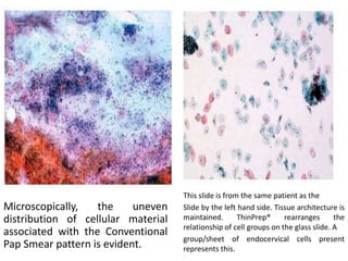 Liquid Based Cytology.pptx