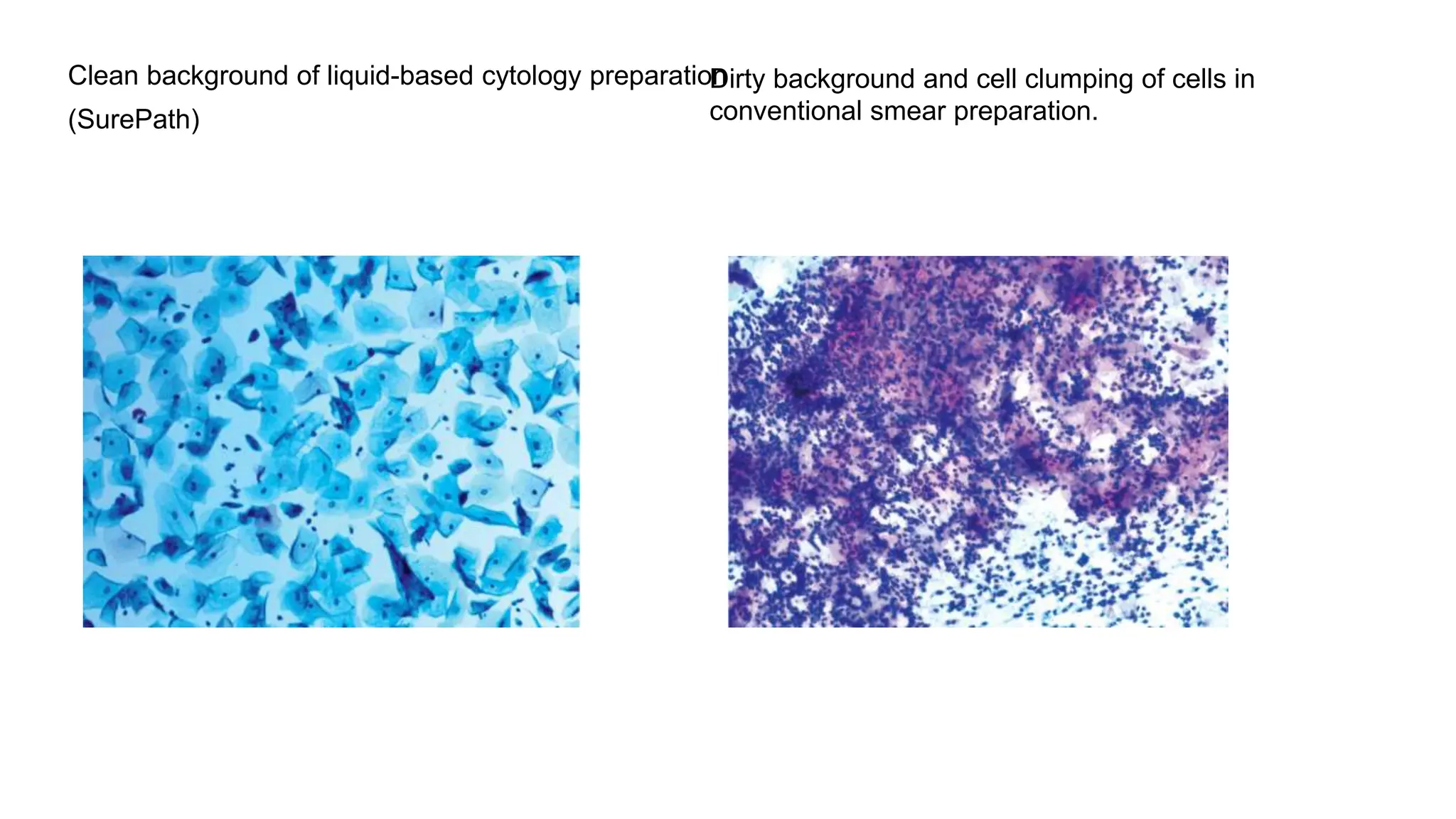 Liquid based cytology pathology CYTOLOGY.pptx