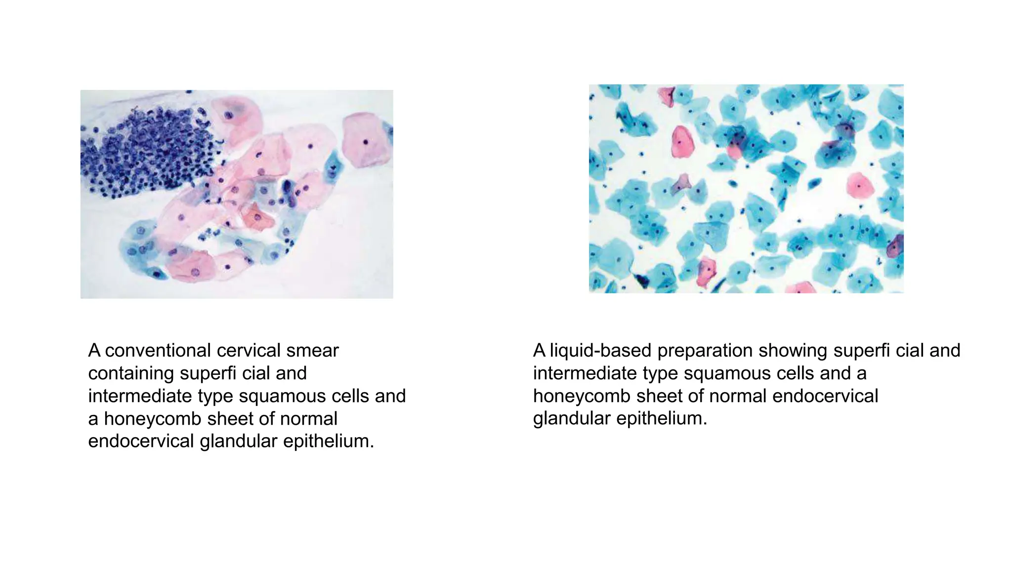 Liquid based cytology pathology CYTOLOGY.pptx
