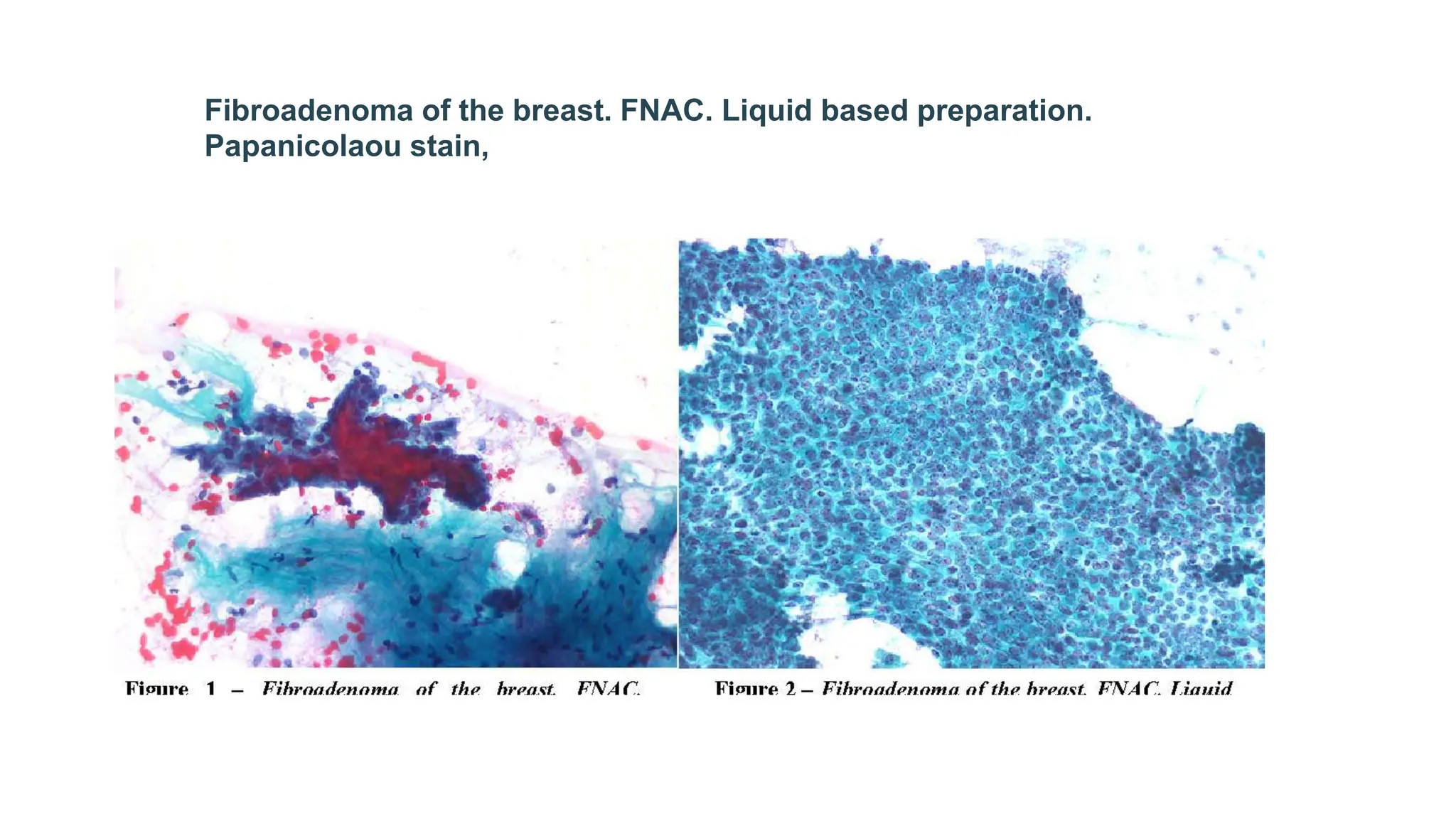 Liquid based cytology pathology CYTOLOGY.pptx