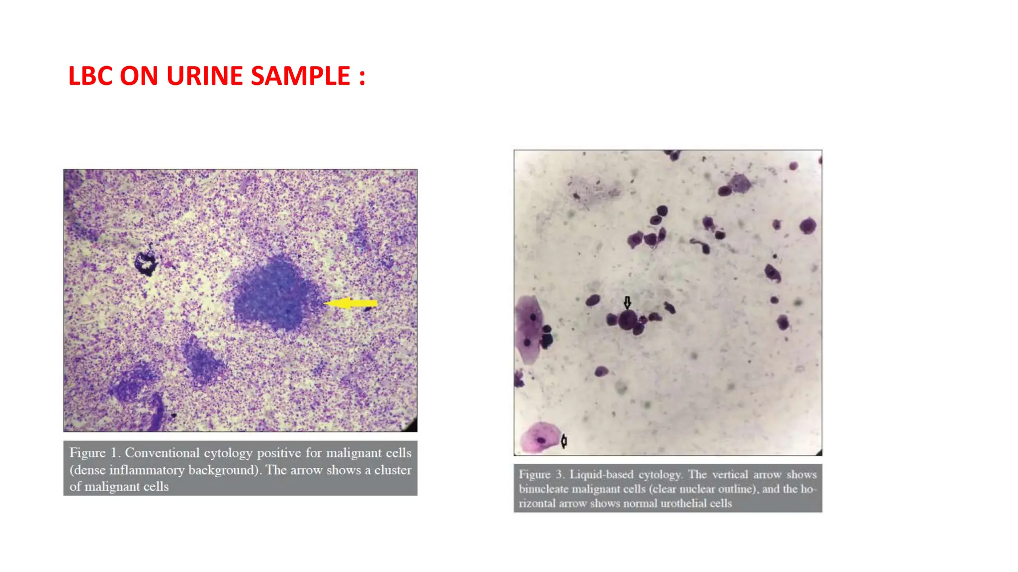 Liquid based cytology pathology CYTOLOGY.pptx