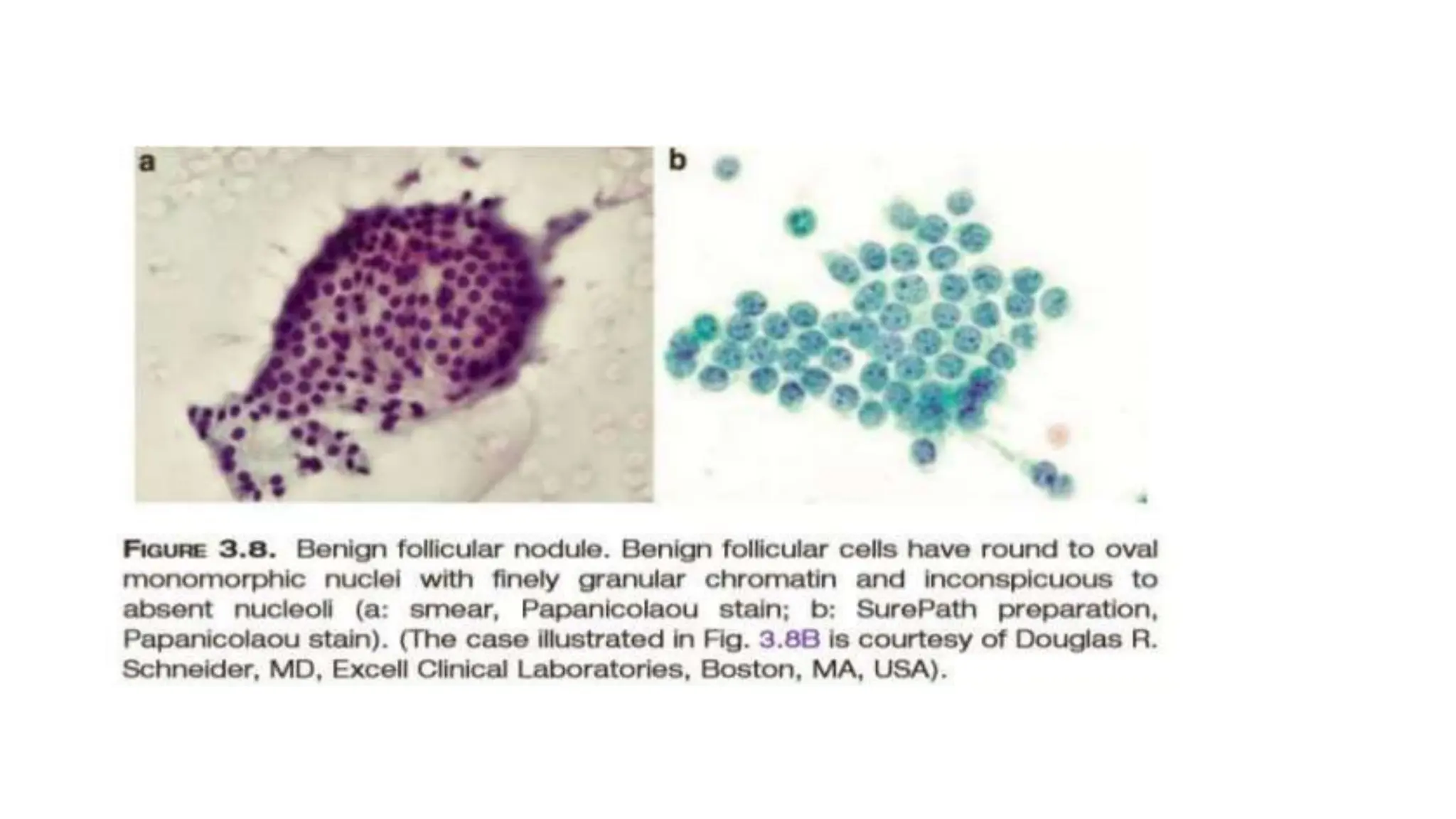Liquid based cytology pathology CYTOLOGY.pptx