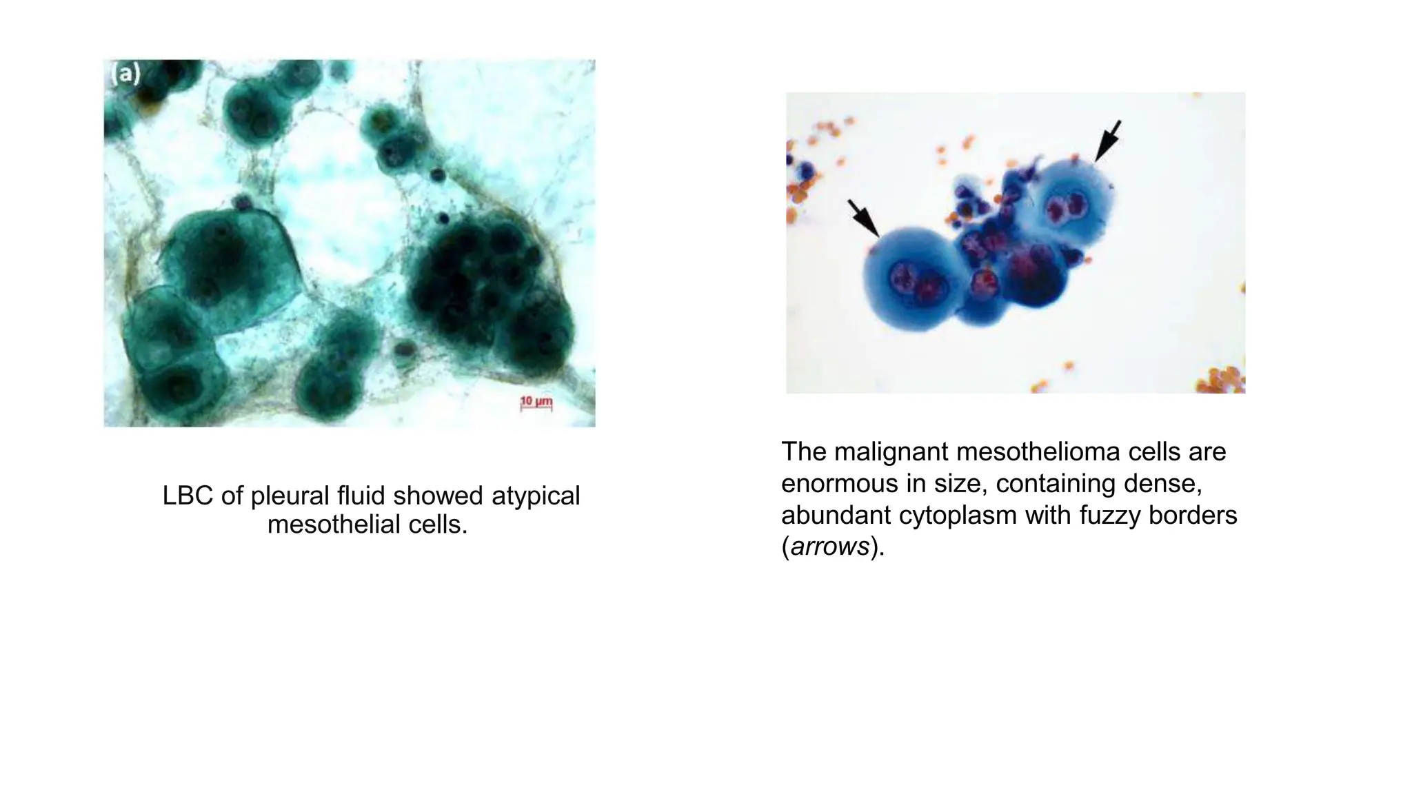 Liquid based cytology pathology CYTOLOGY.pptx