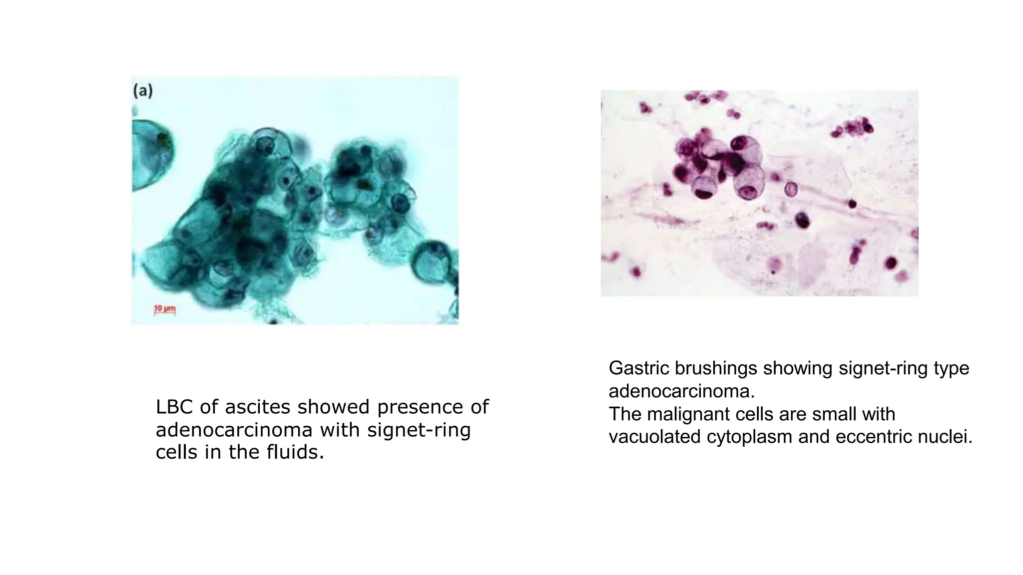 Liquid based cytology pathology CYTOLOGY.pptx